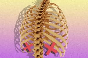 Rib Removal Surgery - Cost, Importance and Risks - Sutured