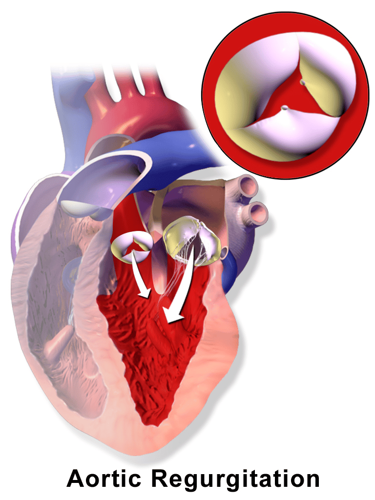 Aortic Valve Repair Techniques - Sutured