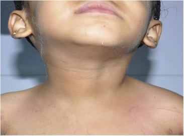 Branchial Cleft Cyst Surgery | Branchial Cleft Cyst Treatment - Sutured