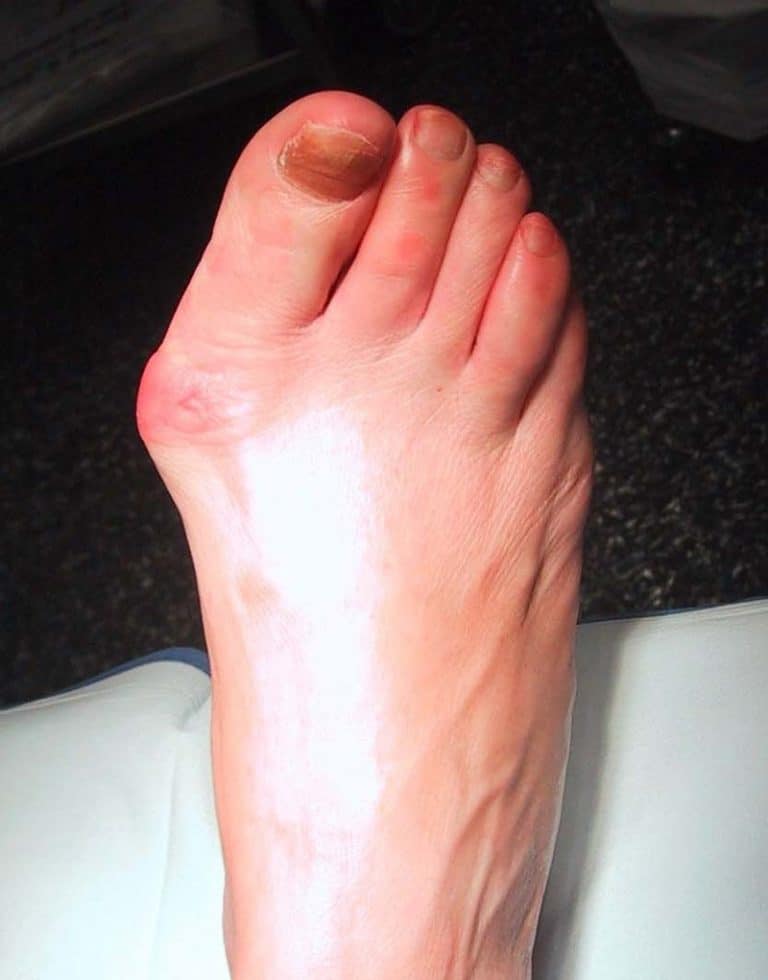 Bunionectomy | Bunion Surgery | Bunionectomy Recovery | Cost - Sutured