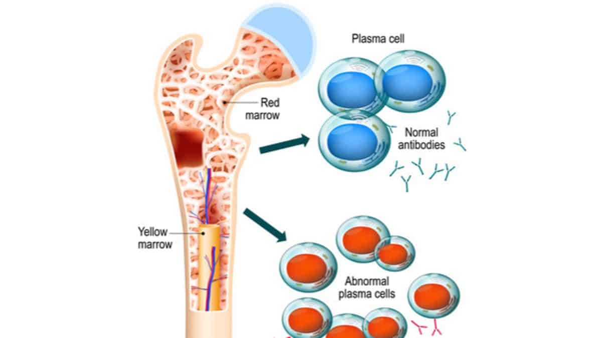 Multiple Myeloma Treatment - Sutured