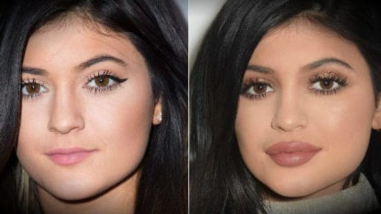Lip Augmentation Surgery | Risk | Complications | Cost | Before and After