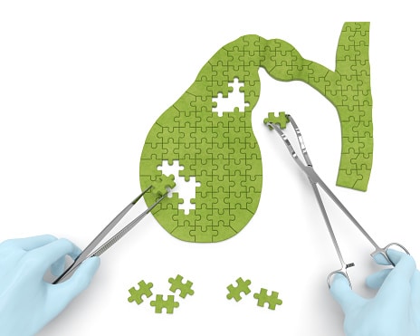 Gallbladder Surgery Recovery Time - Sutured