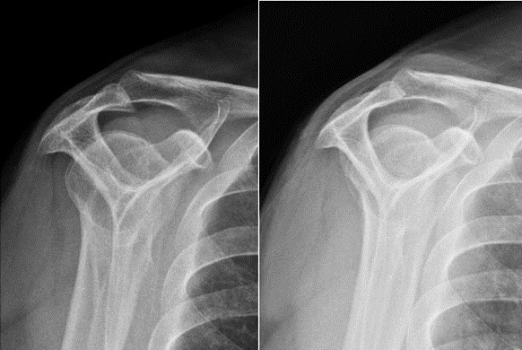 Bankart Repair | Types I Procedure | Recovery - Sutured