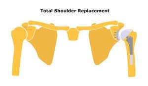 Total Shoulder Replacement | Indications | Cost - Sutured